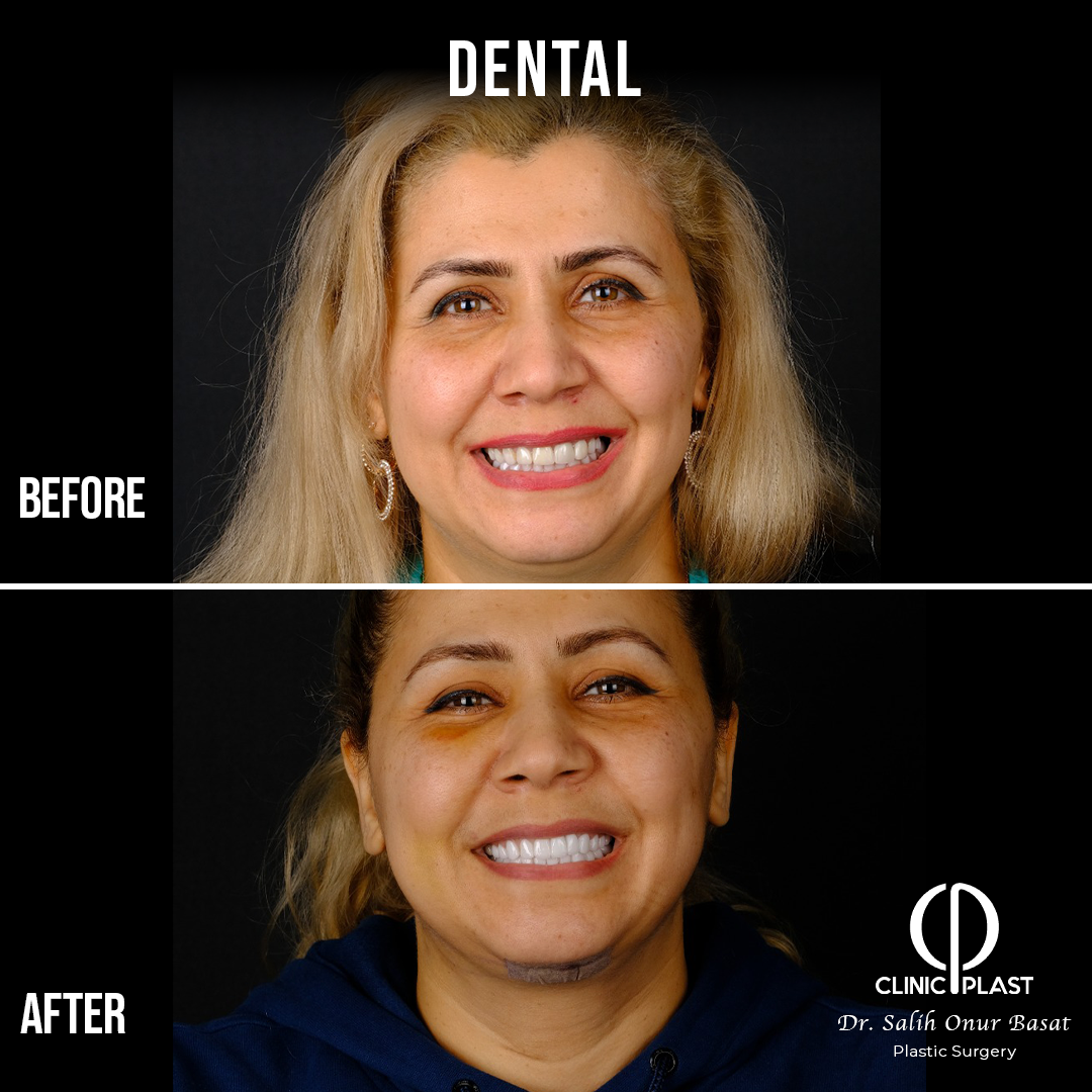 Dental Stone Cleaning Turkey Cost 2024 - Clinicplast